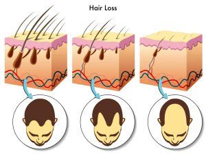 Infected Hair Follicles Treatment To Prevent Stop Hair Loss