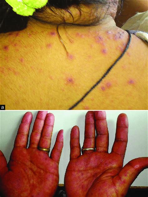Erythema Multiforme Minor Hand