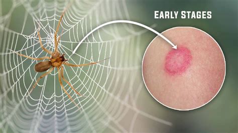 Brown Recluse Bite Stages Day 1 2 3 4 5 With Pictures