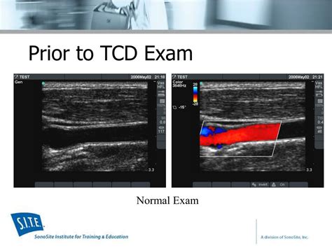 Ppt Introduction To Transcranial Doppler Tcd Powerpoint Presentation Id6593313 Ppt Introduction To Transcranial Doppler Tcd Powerpoint Presentation Id6593313