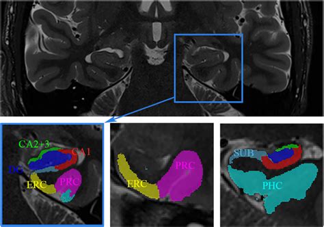 Figure 1 From The Medial Temporal Lobe Structure And Function Support Positive Affect Semantic