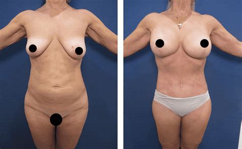 Correcting Contour Irregularities Surgisculpt®