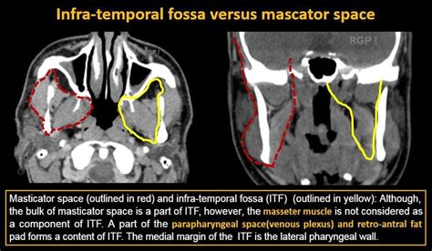 Pin De Mourad Salama En Head And Neck Radiología Anatomía Médica Anatomía