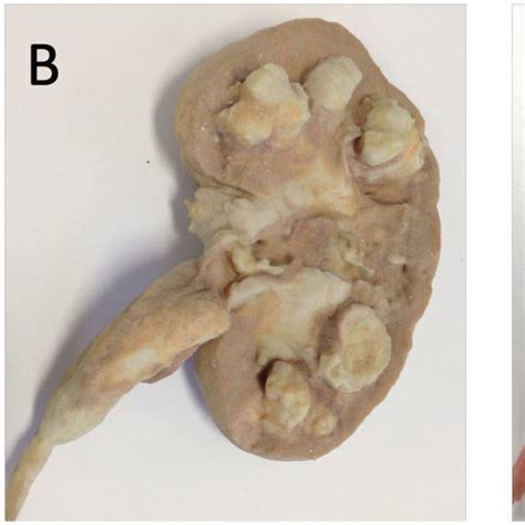 Hydronephrosis And Hydroureter A Original Specimen Photograph B Download Scientific