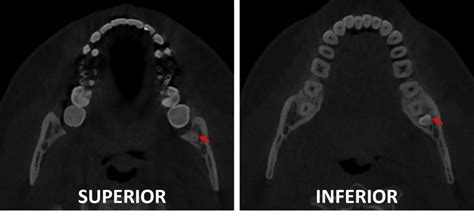 Distomolar En Mandíbula Dento Metric Radiología Dental Oral Y