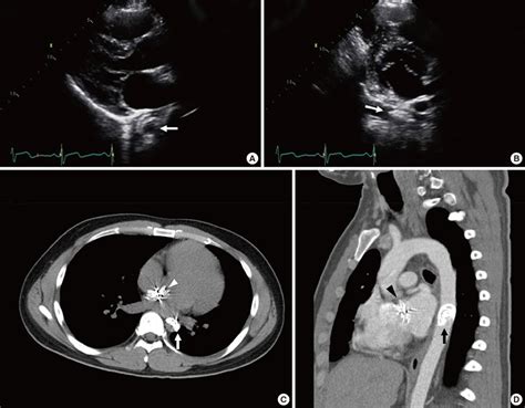 Percutaneous Retrieval Of Embolized Amplatzer Septal Occluder After Treatment Of Double Atrial