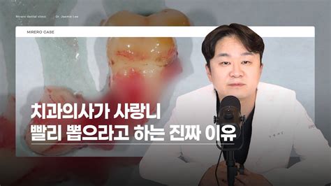 치과의사가 사랑니 빨리 뽑으라고 하는 진짜 이유 Youtube