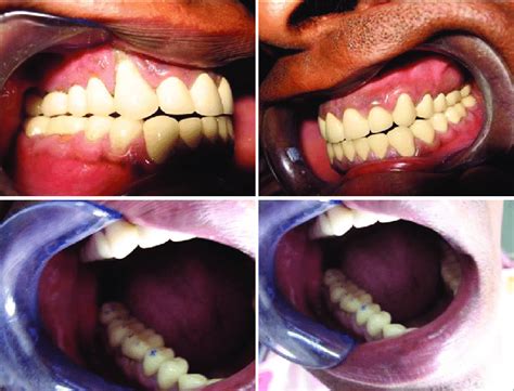 Group Function Type Of Occlusion On Right And Left Sides Download