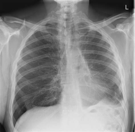 Left Upper Lobectomy