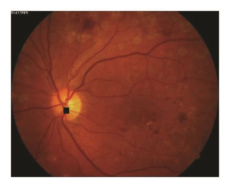 optic disc definition anatomy at timothy charles blog