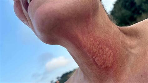 Types Of Jellyfish Stings Pictures