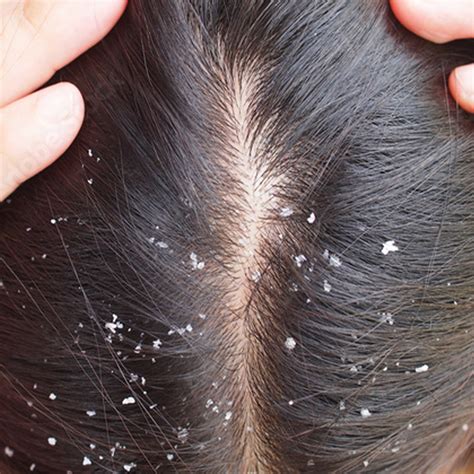 Best Dandruff Treatment Abu Dhabi PRP Plasma Hair Treatment