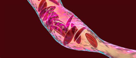 Expanding Gene Therapy For Sickle Cell Disease Regmednet