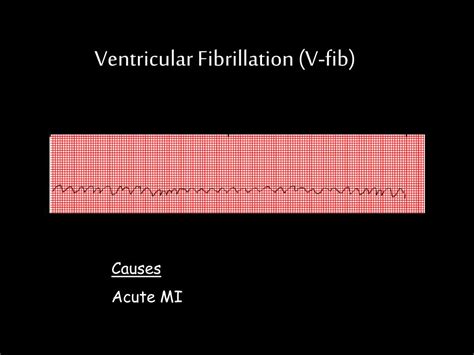 Ppt Cardiac Conduction Powerpoint Presentation Free Download Id 586504