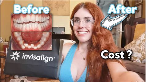 INVISALIGN Everything You Need To Know My Honest Experience FAQ S Tips Before After