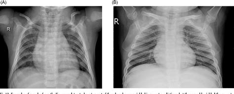 Table From Pneumonia Detection In Chest X Ray Images Using An Ensemble Of Deep Learning