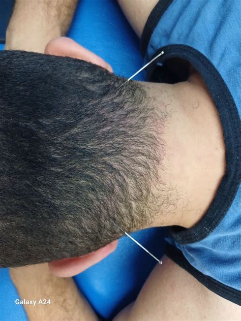 Ahmed Elsabbagh On Linkedin Obliques Capitis Inferior Dry Needle