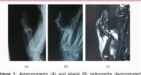 Figure 1 From Irreducible Dislocation Of The Metacarpophalangeal Joint Semantic Scholar
