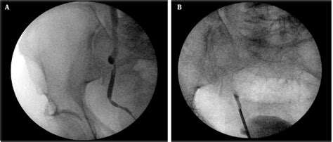 A Retrograde Pyelogram Showing An Area Of Narrowing In The Mid Distal