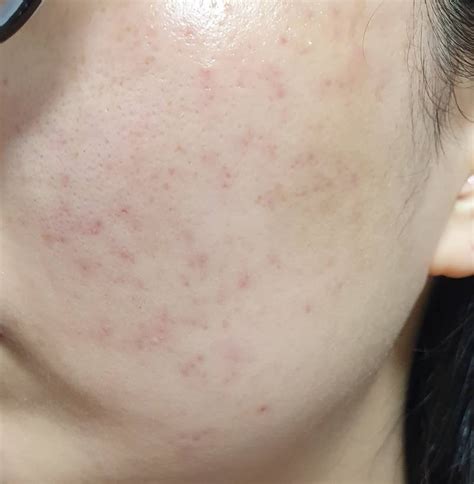 성인 여드름으로 고생하는 익들 나 믿고 이거 한 번만 써봐여드름 사진 주의 인스티즈instiz 일상 카테고리