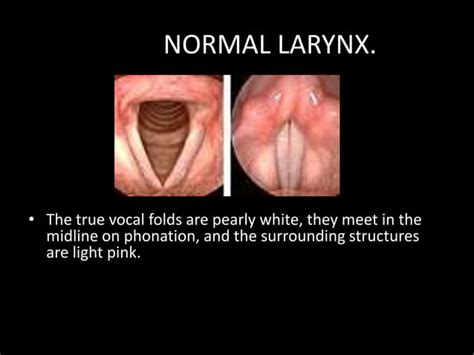 Diseases Of Larynx Pptx Ear Nose And Throat Conditions Diseases And Conditions