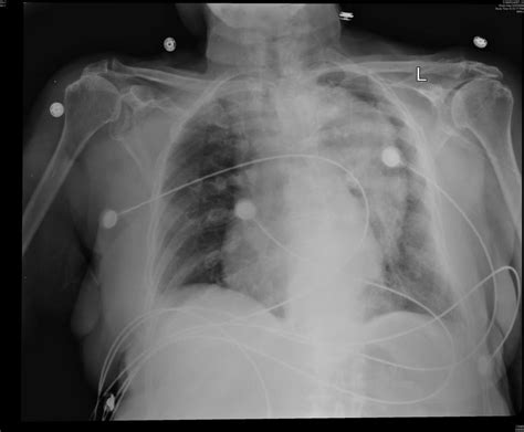 Aortic Dissection X Ray