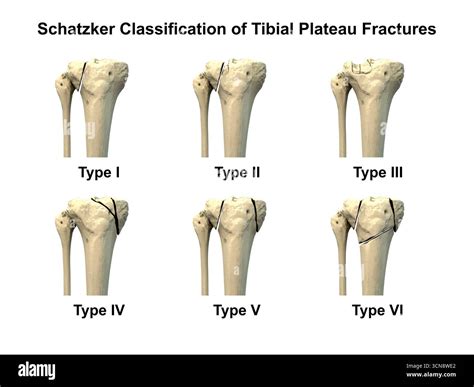 Illustration Of The Schatzker Classification Of Tibial Plateau