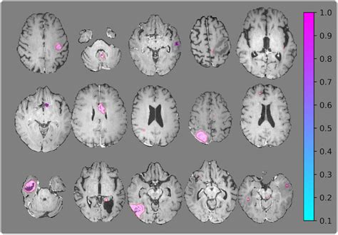2 5d And 3d Segmentation Of Brain Metastases With Deep Learning On Multinational Mri Data Pmc