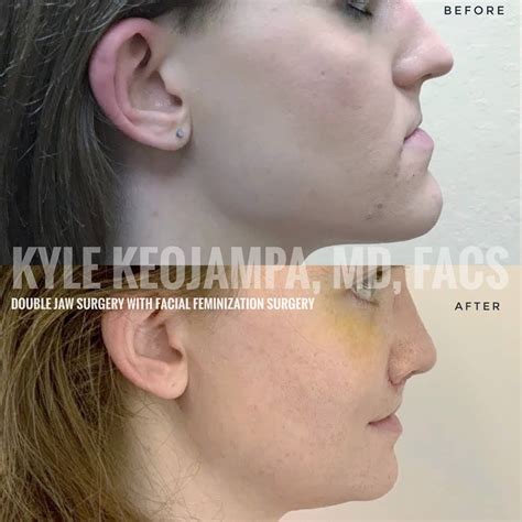 Maxillary Surgery Before And After