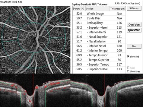 Radial Peripapillary Capillary Vessel Density Rpcvd Was Automatically