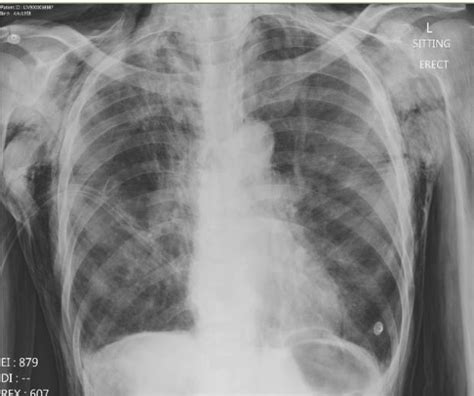 Chest X Ray Extensive Subcutaneous Emphysema Lungs Fully Expanded And Download Scientific