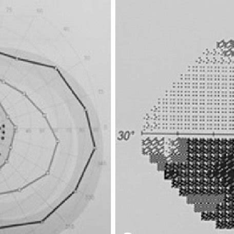 Octopus Visual Field A And Humphrey Visual Field B Of The Download Scientific Diagram Octopus Visual Field A And Humphrey Visual Field B Of The Download Scientific Diagram