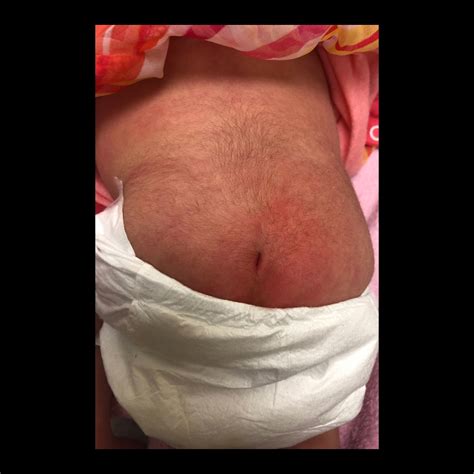 Newborn With A Sacral Dimple Pediatric Radiology Case Pediatric
