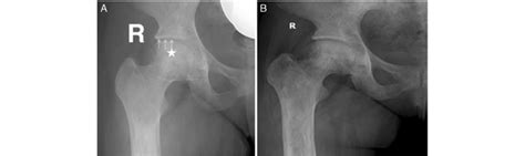 A AP View Of The Pelvis Demonstrating Patches Of Sclerosis With Coarse Download Scientific