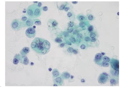 Malignant Cells In Pleural Fluid