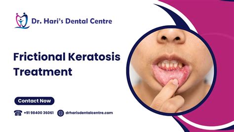 Frictional Keratosis Treatment In Chennai 100 Expert Care