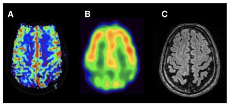 Dsc Brain Perfusion Using Advanced Deconvolution Models In The Diagnostic Work Up Of Dementia