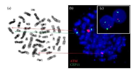 The Patients Bone Marrow Cell Culture A Metaphase Staining By Download Scientific Diagram