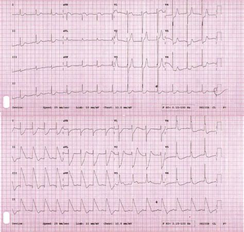 12 Lead Electrocardiogram A Presence Of St Elevation Over Ecg Leads Download Scientific