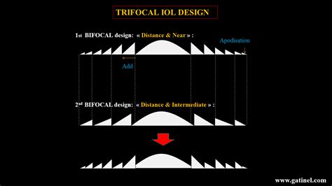 Trifocal Iol Cataract Implant Docteur Damien Gatinel