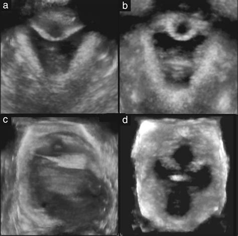 Space Of Retzius Ultrasound
