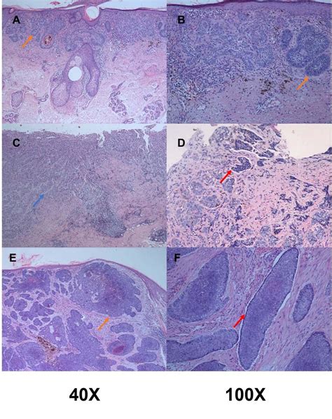 Histopathology Of Three Skin Lesions Discrete Nests Of Basaloid Cells Download Scientific