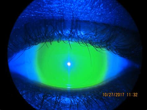 Scleral Contact Lenses For Eye Disease Hilltop Eyecare Pllc