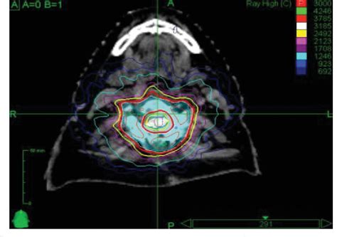 Figure 1 From Consensus Guidelines For Postoperative Stereotactic Body