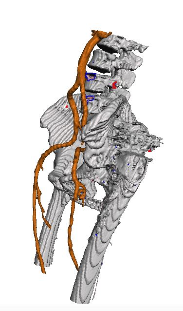 🗿 aorta femoral and iliac aortoiliac and femoral vessels・ stl file