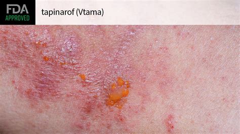 Nonsteroidal Topical Okd For Atopic Dermatitis
