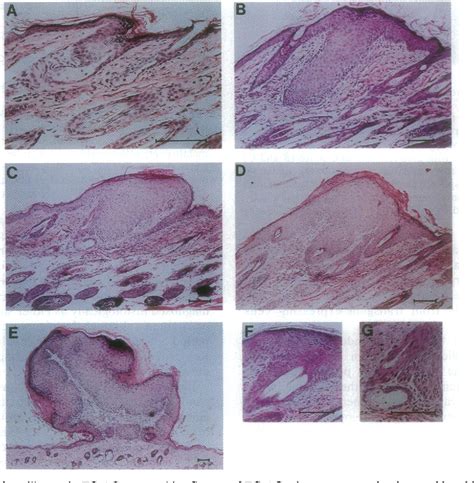 Figure 1 From Follicular Origin Of Epidermal Papillomas In V Ha Ras Transgenic Tg Ac Mouse Skin