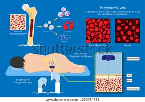 Polycythemia Vera ~ News Word