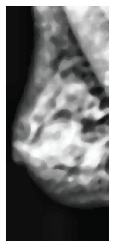 mammographic image processing a removing blank space b image