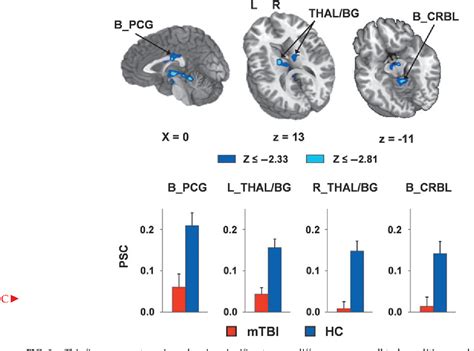 Figure 1 From An Fmri Study Of Auditory Orienting And Inhibition Of Return In Pediatric Mild